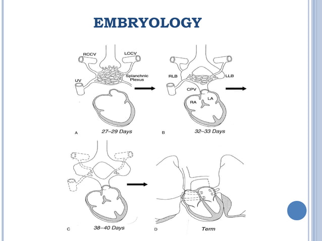 TOTAL ANOMALOUS PULMONARY VENOUS CONNECTION (TAPVC) | PPT | Lung and ...