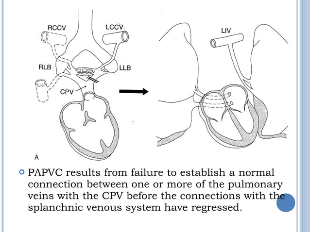 TOTAL ANOMALOUS PULMONARY VENOUS CONNECTION (TAPVC) | PPT | Lung and ...