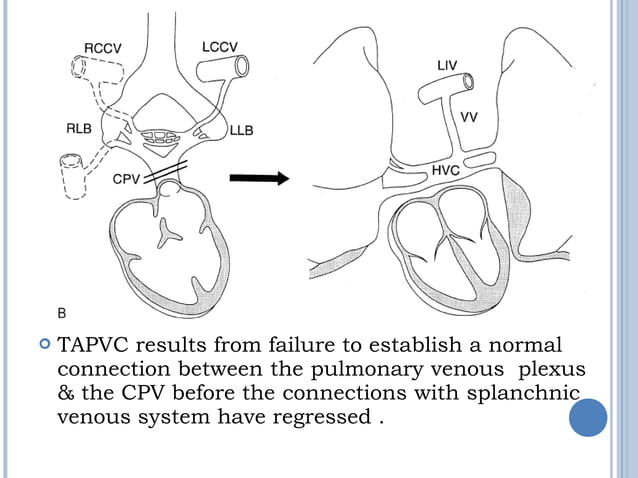 TOTAL ANOMALOUS PULMONARY VENOUS CONNECTION (TAPVC)
