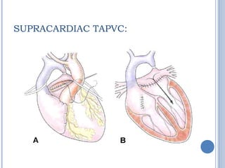 Total Anomalous Pulmonary Venous Return
