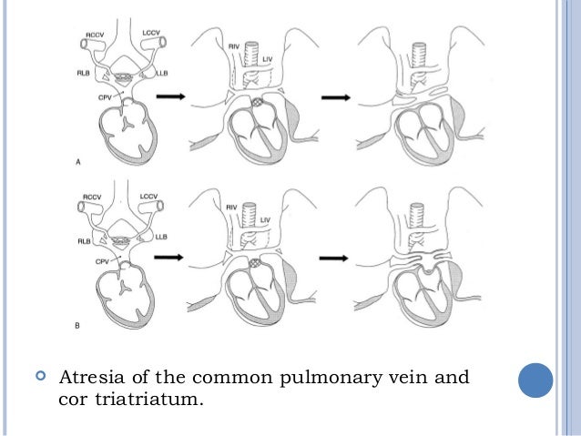 TOTAL ANOMALOUS PULMONARY VENOUS CONNECTION (TAPVC)
