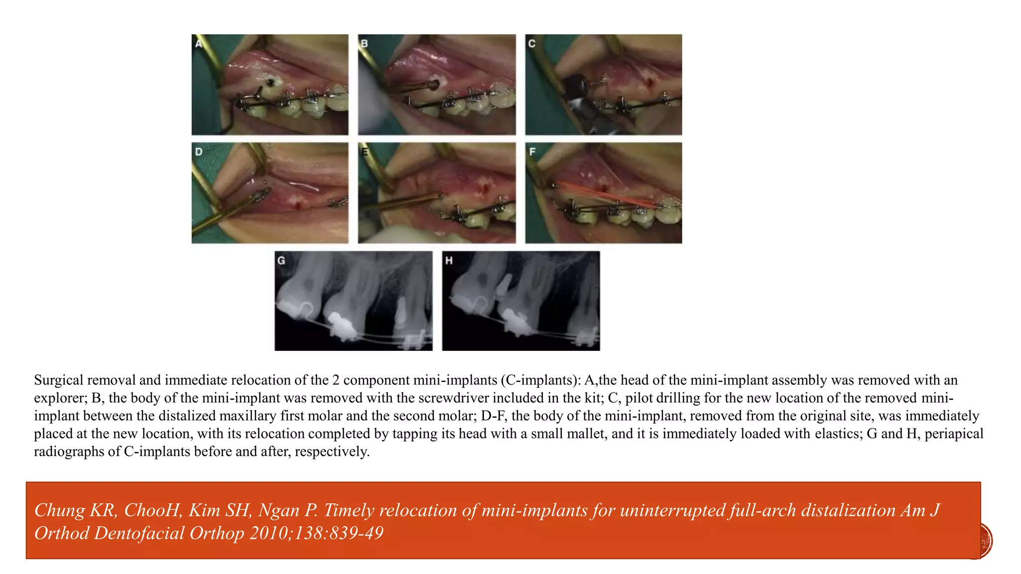 Total arch distalization in orthodontics | PPTX
