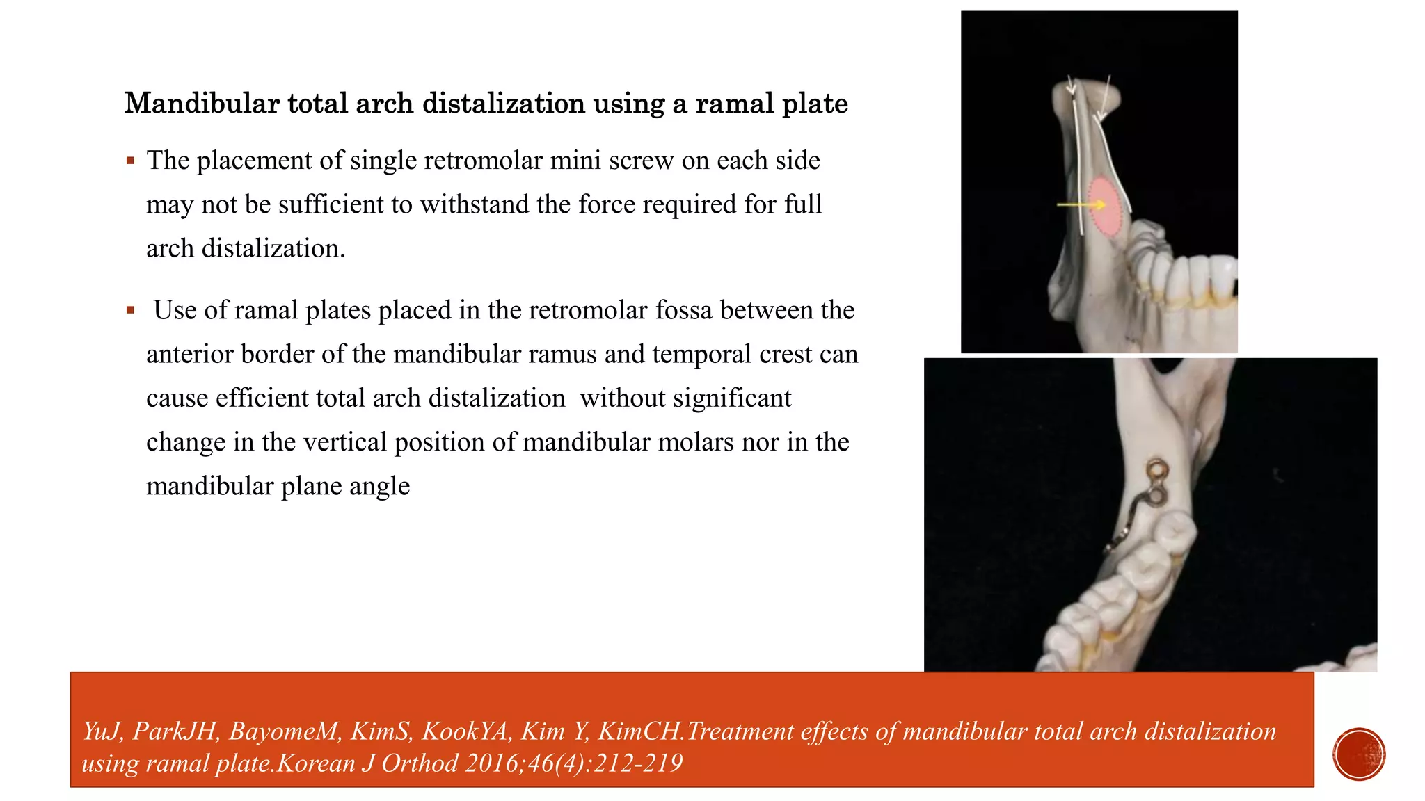 Total arch distalization in orthodontics | PPTX
