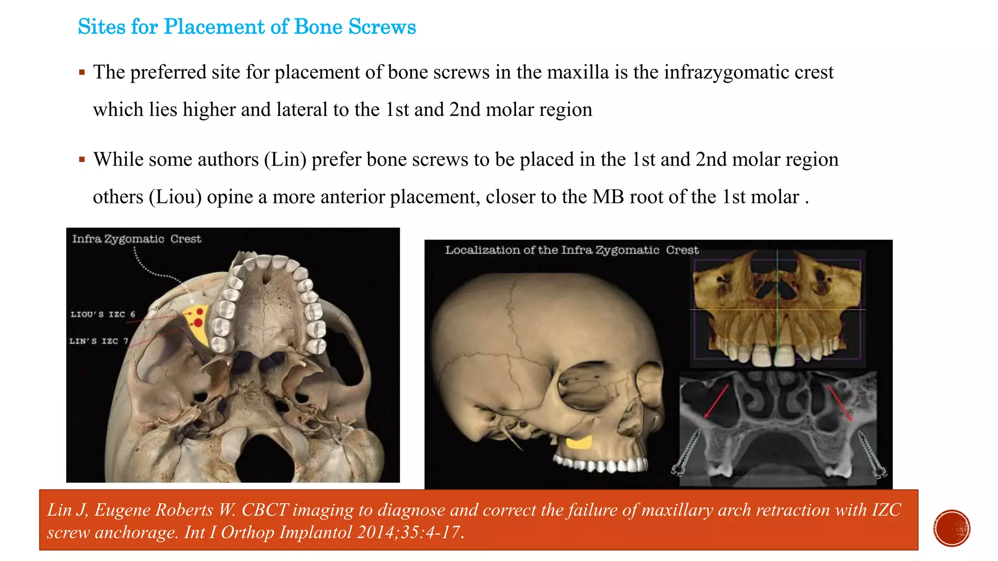 Total arch distalization in orthodontics | PPTX