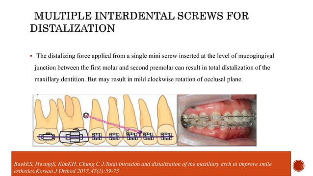 Total arch distalization in orthodontics | PPTX | Dental Health ...