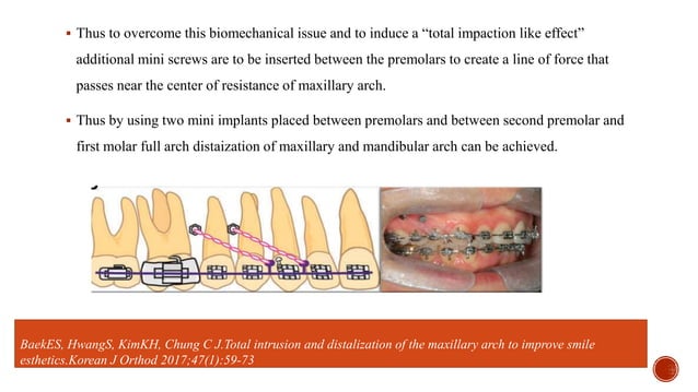 Total arch distalization in orthodontics | PPTX | Dental Health ...