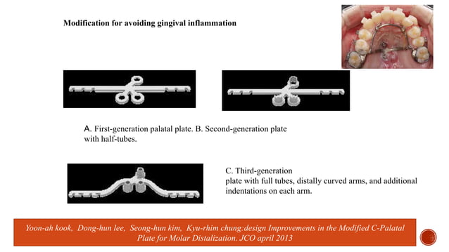 Total arch distalization in orthodontics | PPTX | Dental Health ...