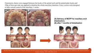 Total arch distalization in orthodontics | PPTX