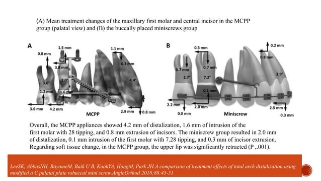 Total arch distalization in orthodontics | PPTX | Dental Health ...