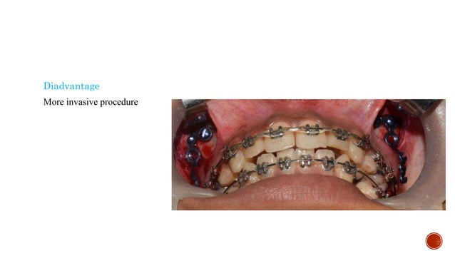 Total arch distalization in orthodontics | PPTX | Dental Health ...