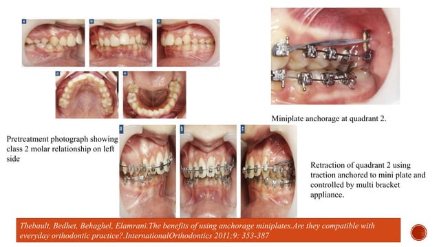 Total arch distalization in orthodontics | PPTX | Dental Health ...
