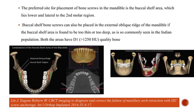 Total arch distalization in orthodontics | PPTX | Dental Health ...