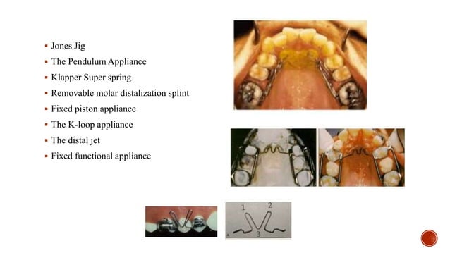 Total arch distalization in orthodontics | PPTX | Dental Health ...