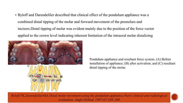 Total arch distalization in orthodontics | PPTX | Dental Health ...