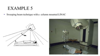 Total body irradiation- Indications, Techniques and Complications | PPTX