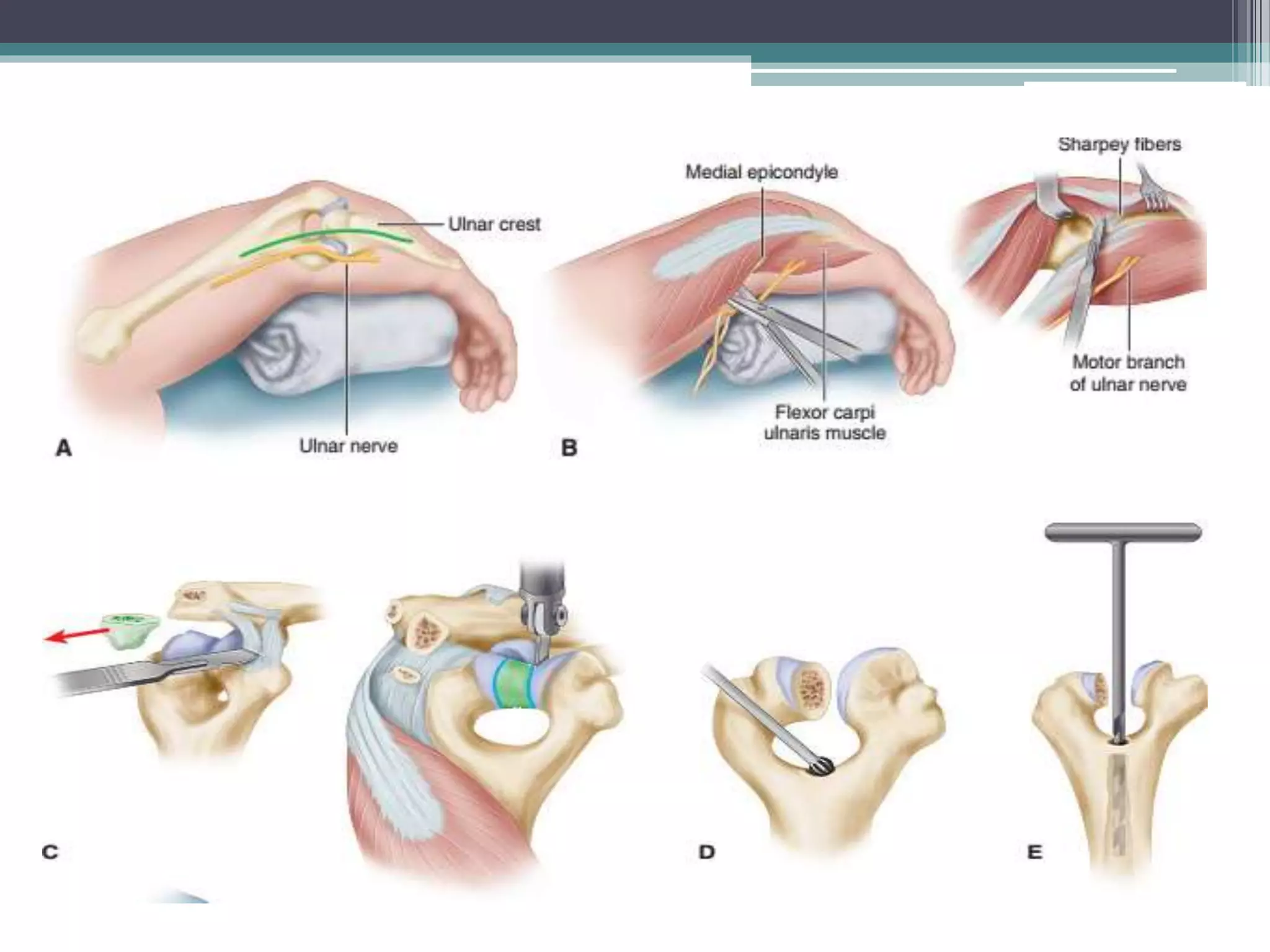 Total elbow arthroplasty | PPTX