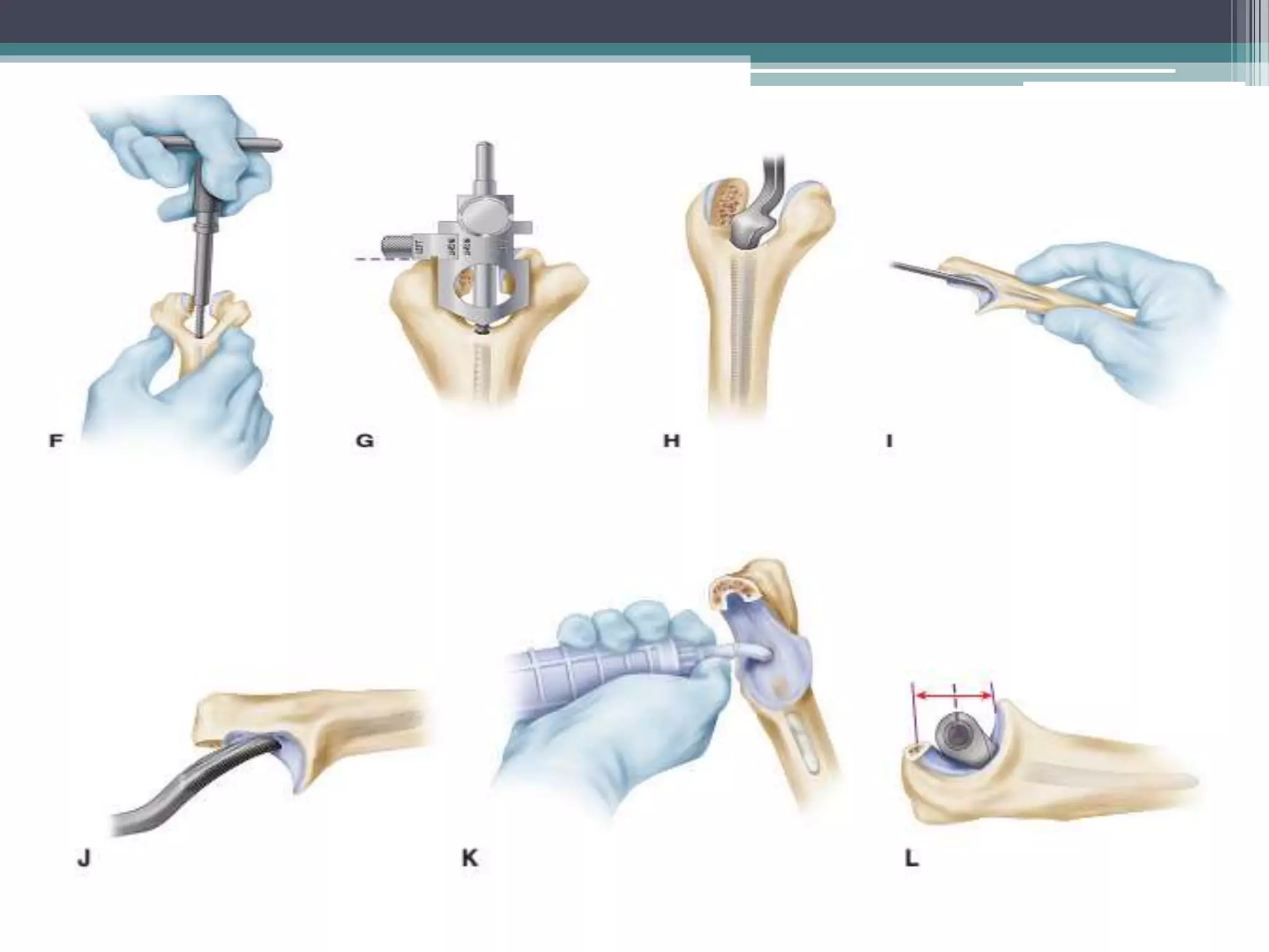 Total elbow arthroplasty | PPTX