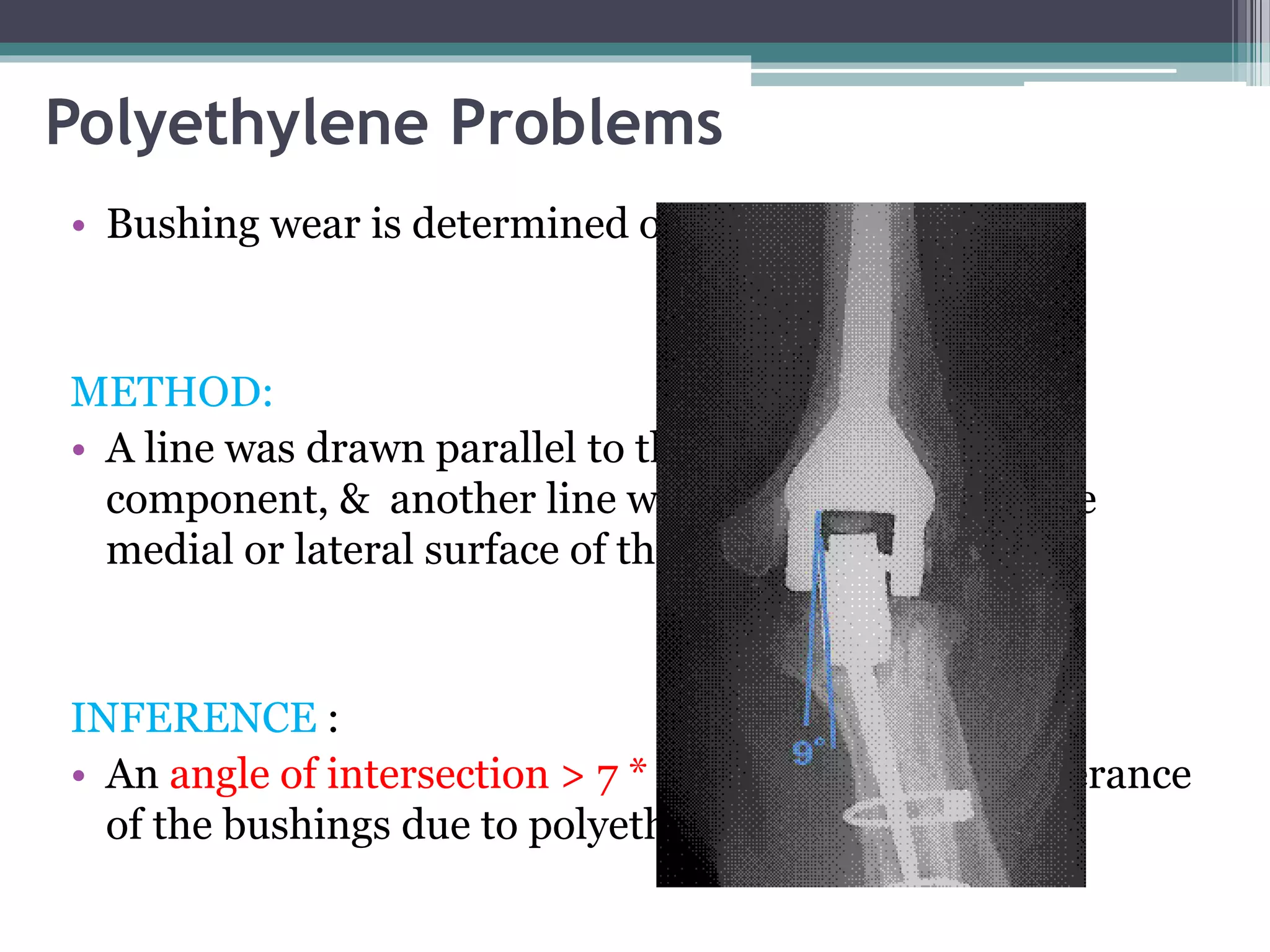 Total elbow arthroplasty | PPTX