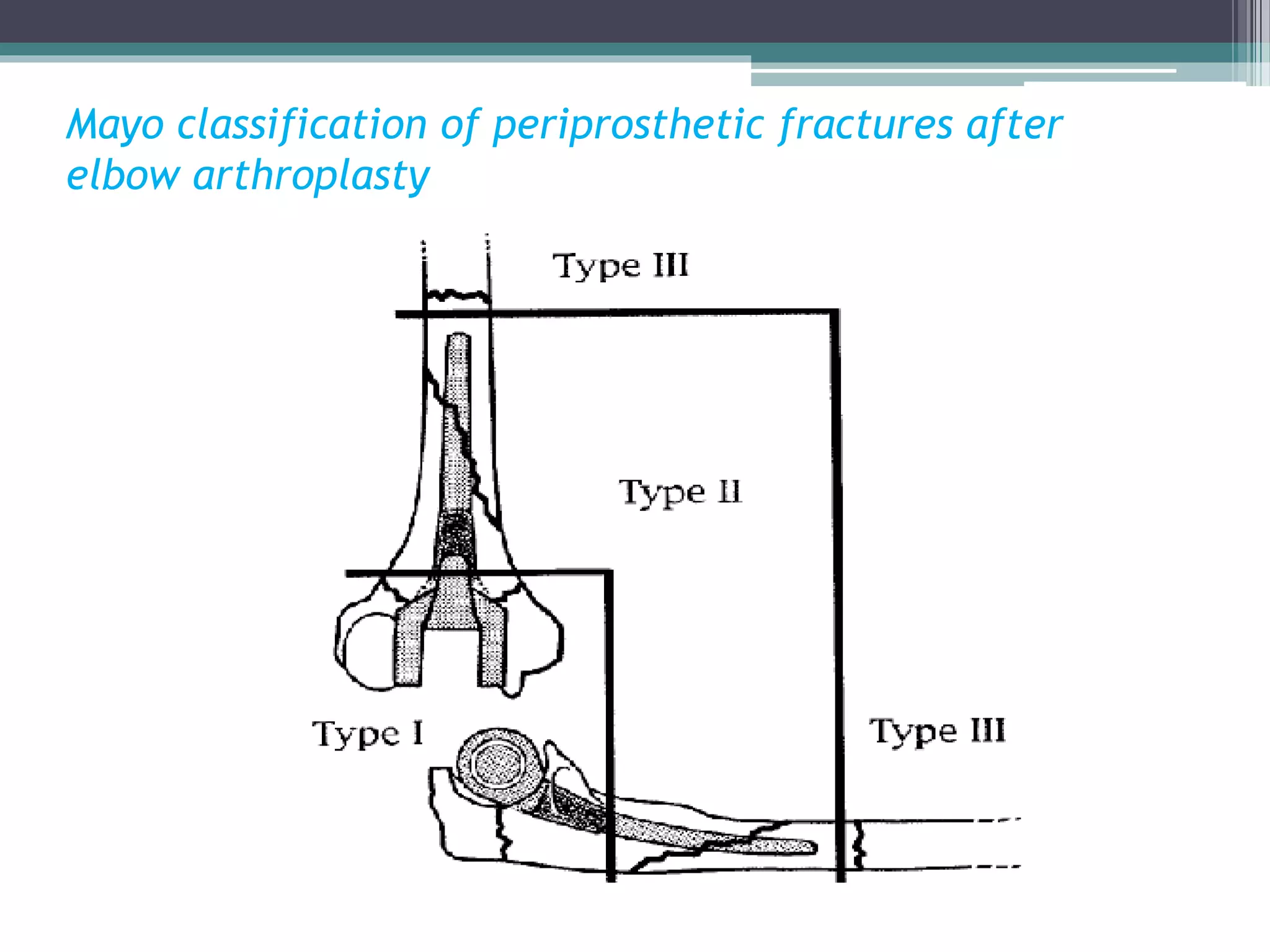 Total elbow arthroplasty | PPTX