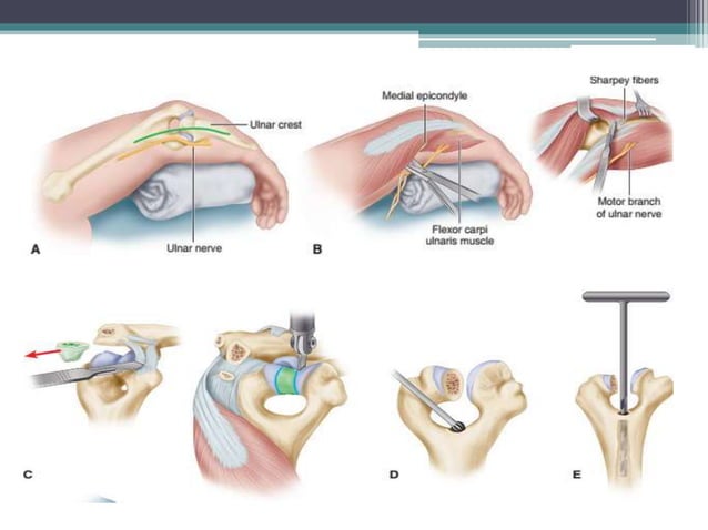 Total elbow arthroplasty | PPTX