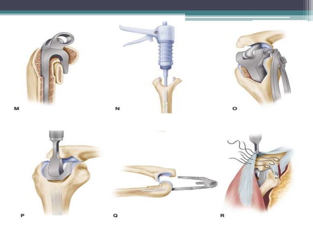 Total elbow arthroplasty | PPT