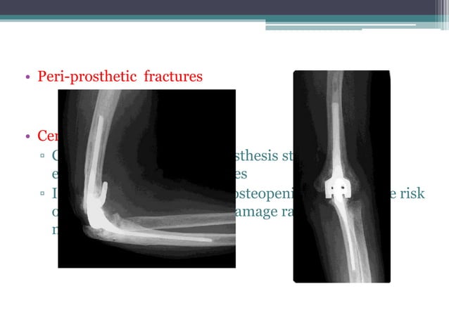 Total elbow arthroplasty | PPTX