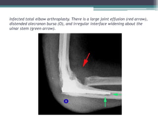Total elbow arthroplasty | PPTX