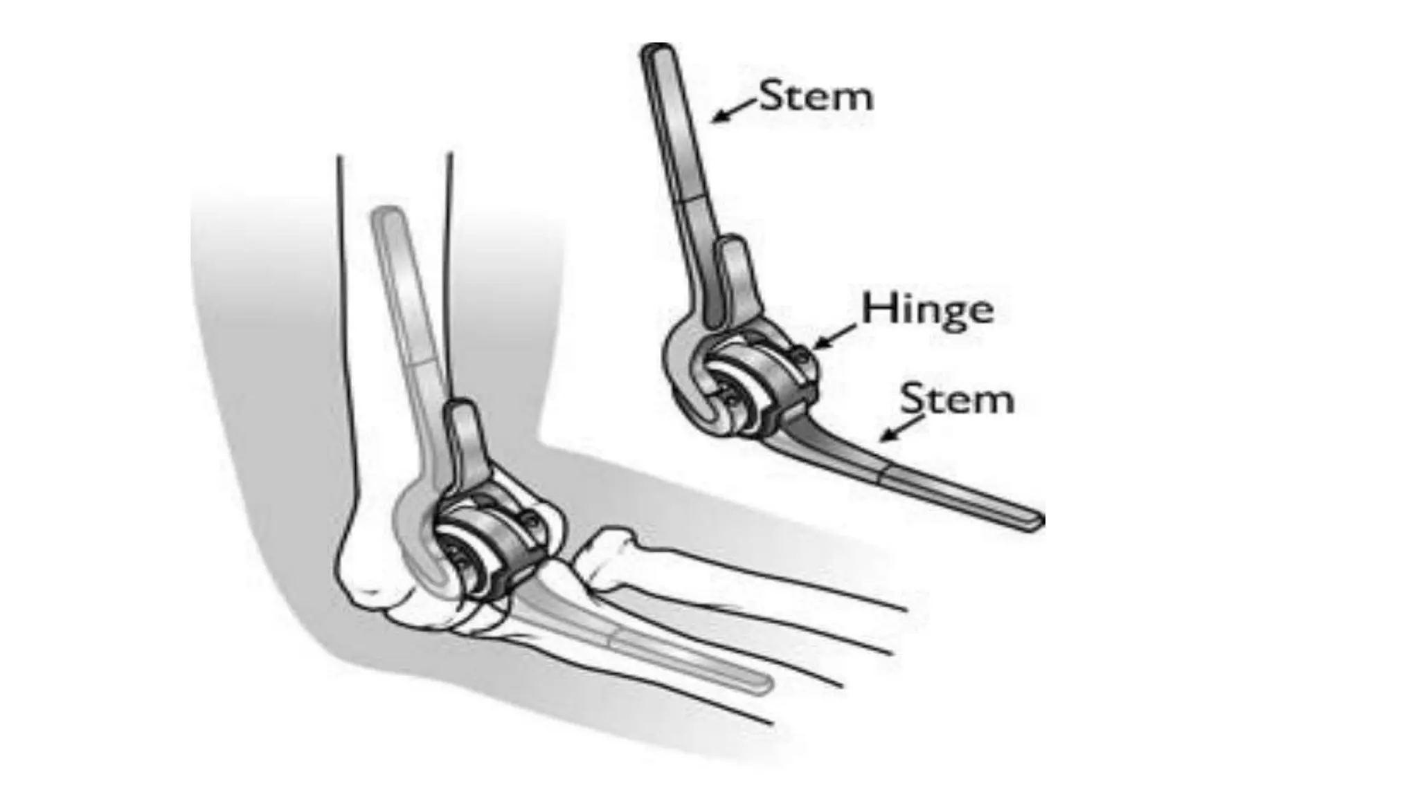 Total elbow arthroplasty | PPTX