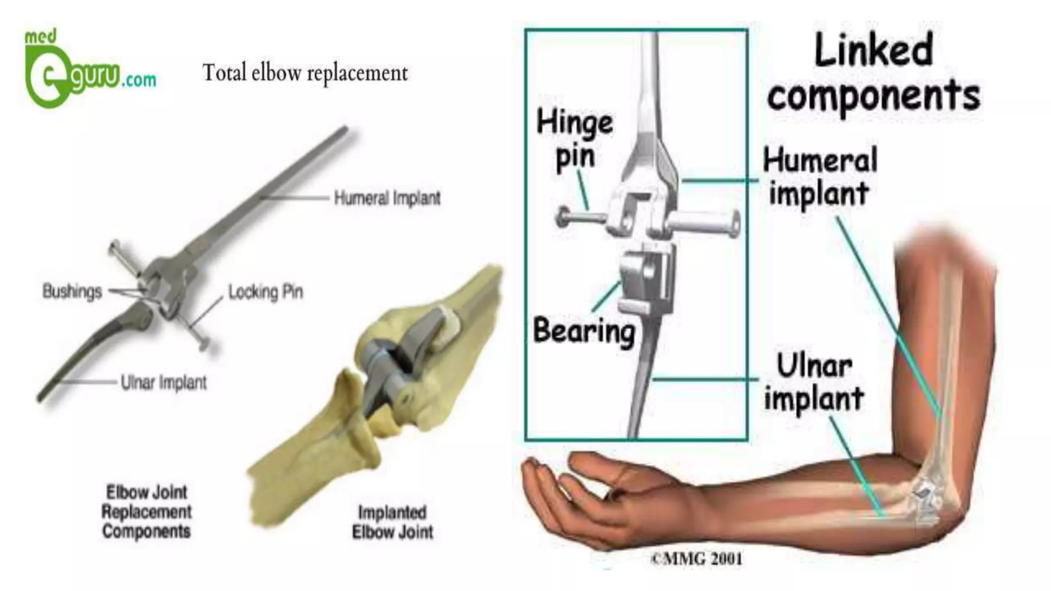 Total elbow arthroplasty | PPTX