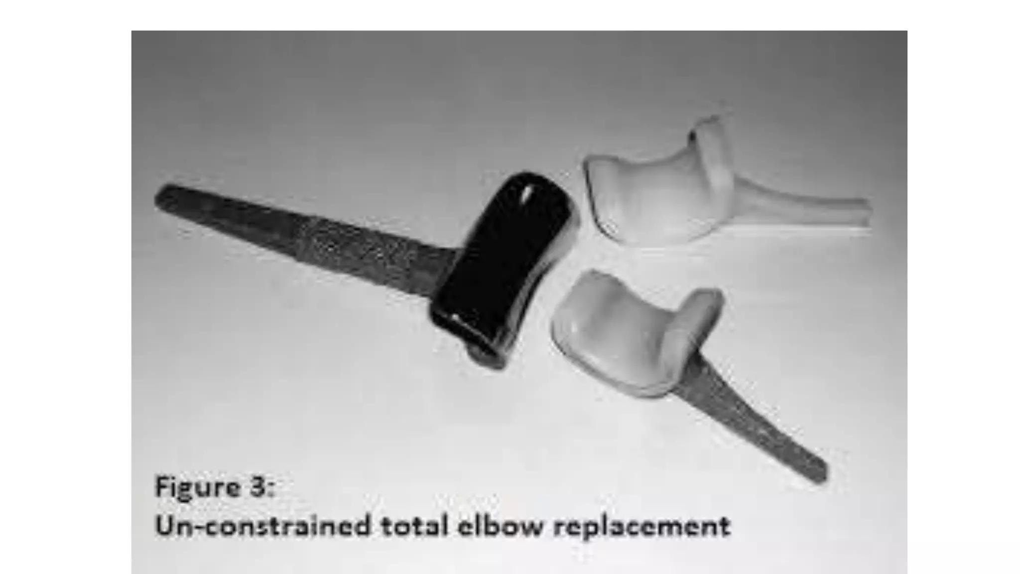 Total elbow arthroplasty | PPTX