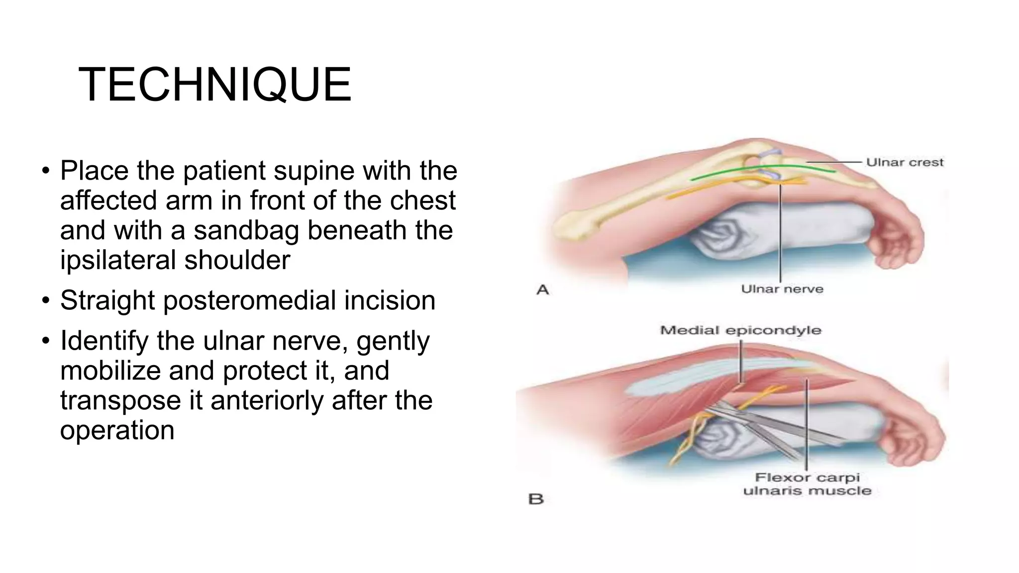 Total elbow arthroplasty | PPTX