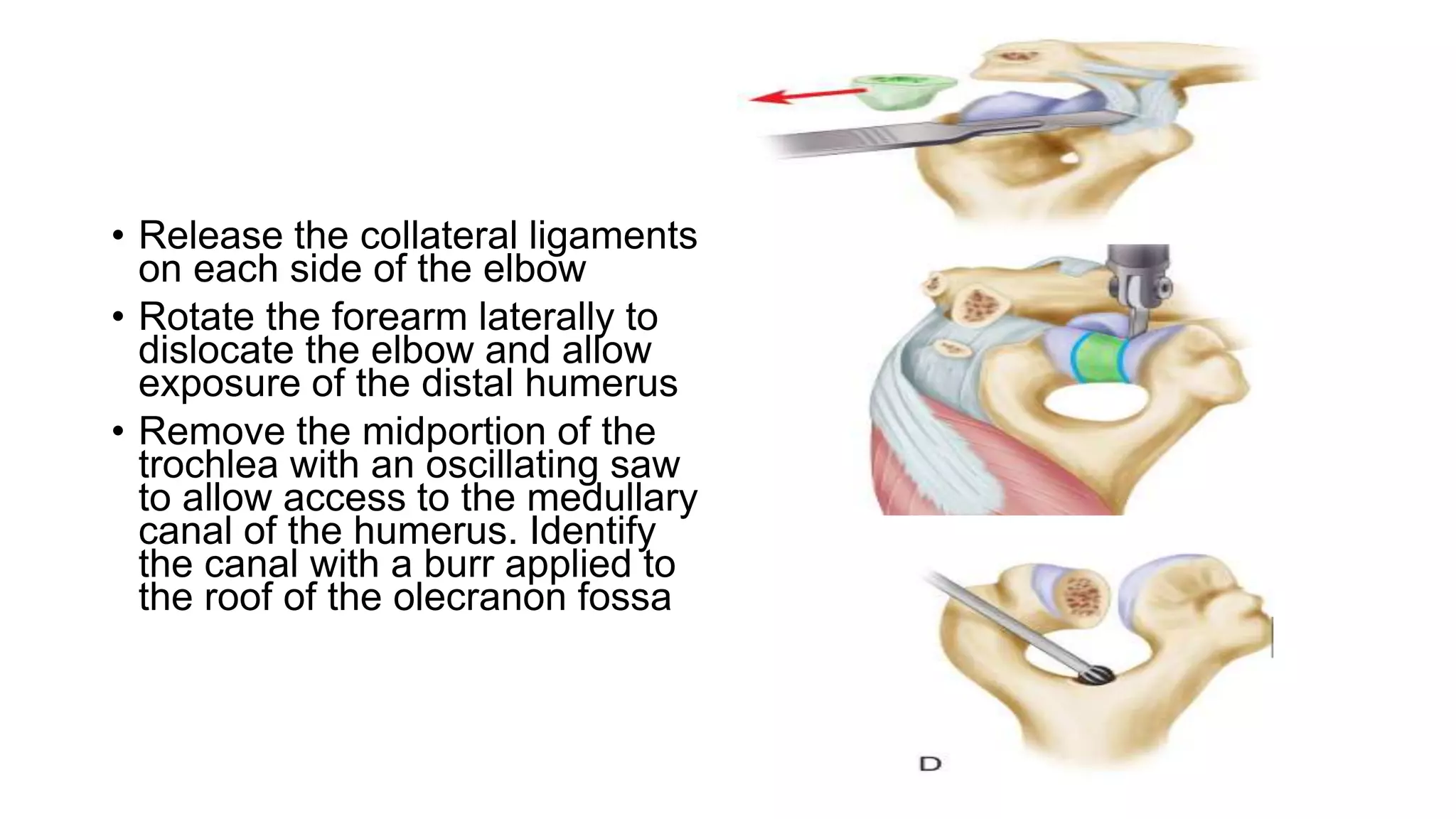 Total elbow arthroplasty | PPTX