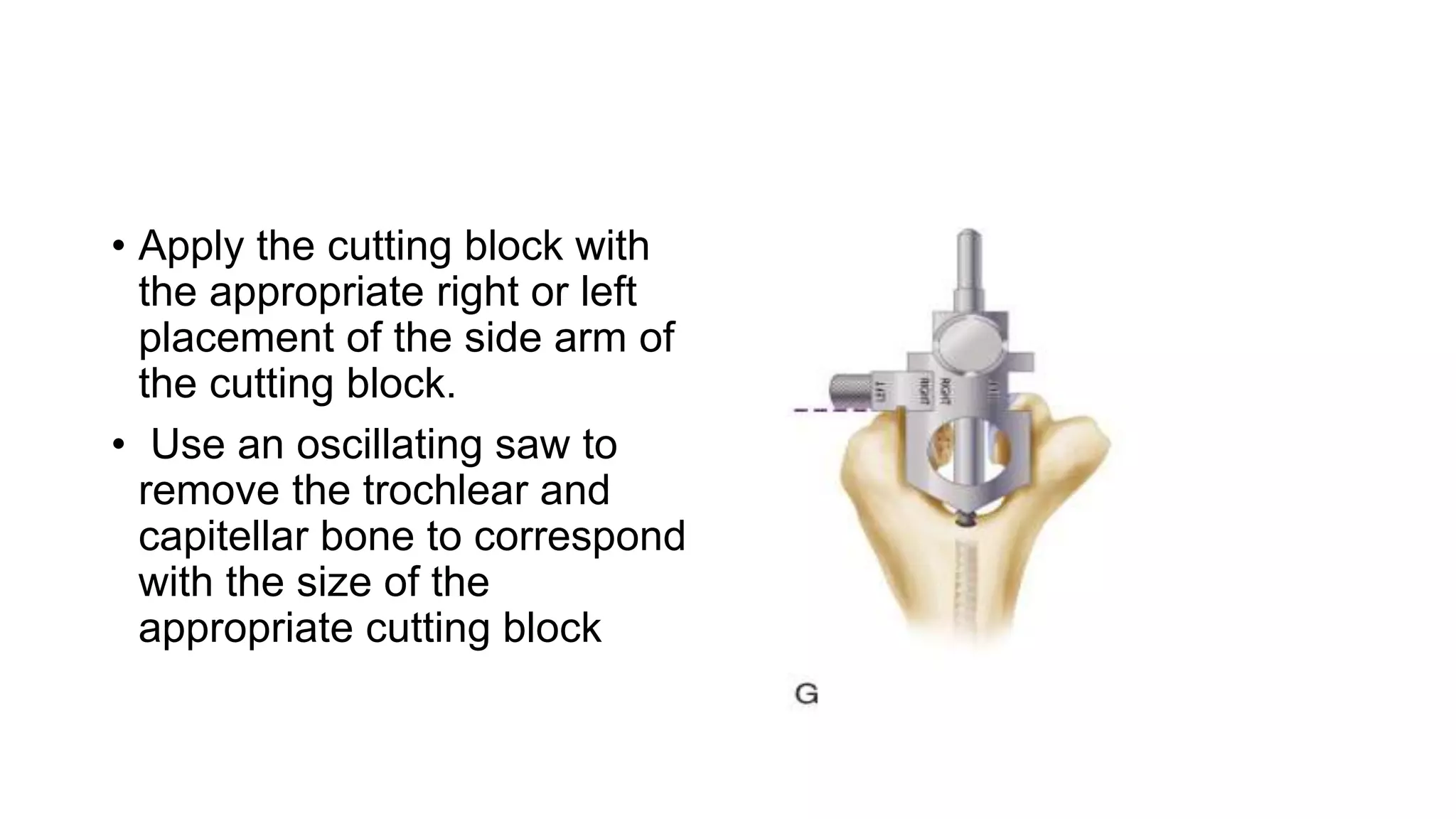 Total elbow arthroplasty | PPTX
