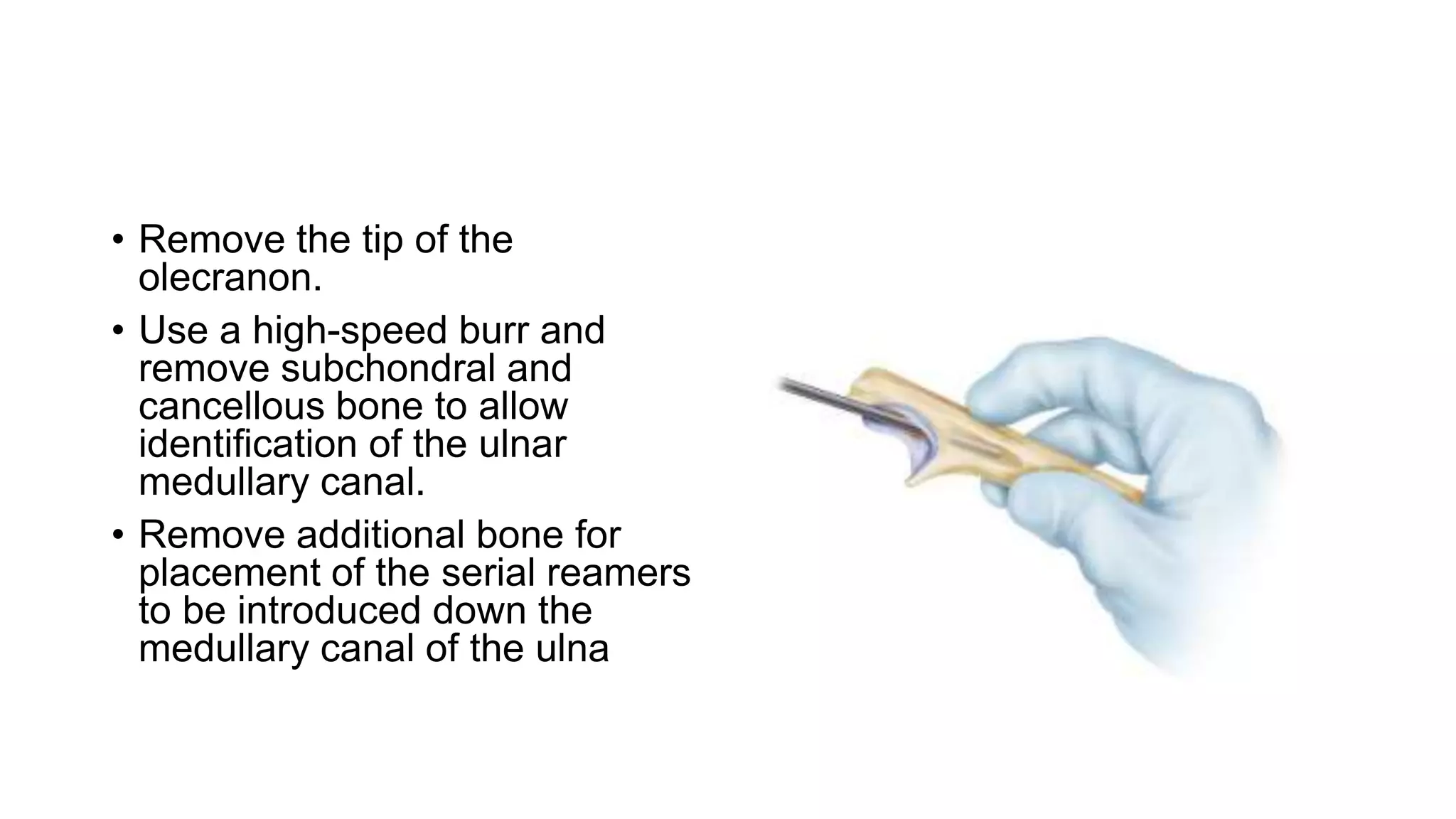 Total elbow arthroplasty | PPTX