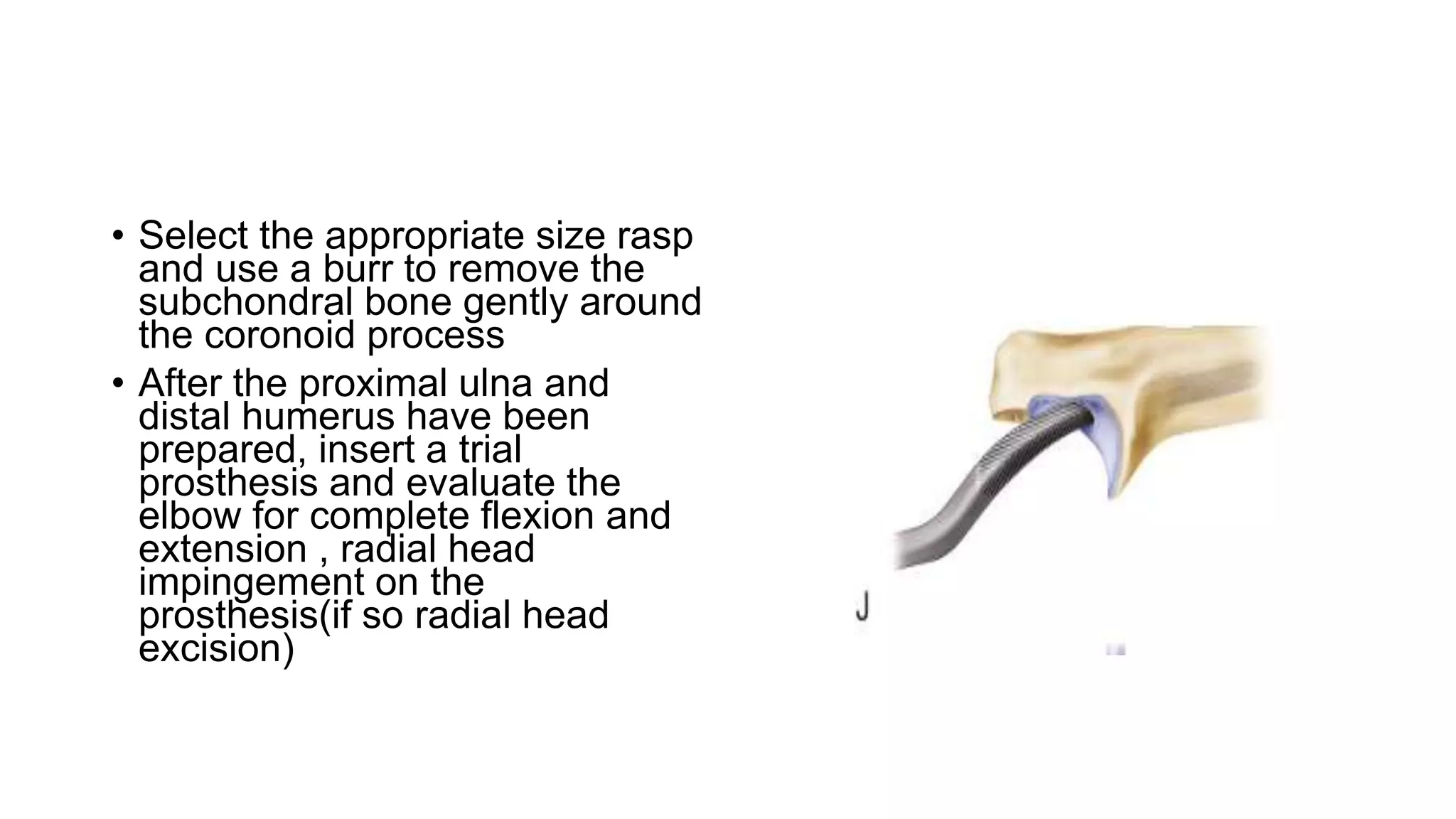Total elbow arthroplasty | PPTX