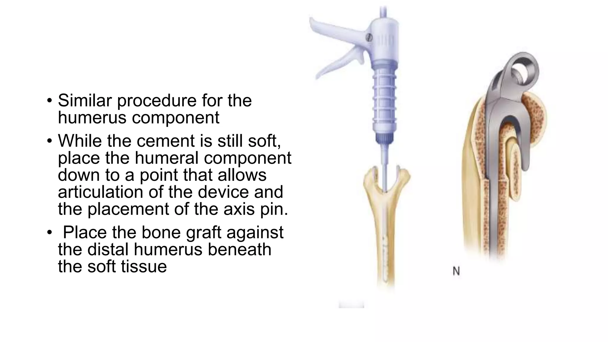 Total elbow arthroplasty | PPTX