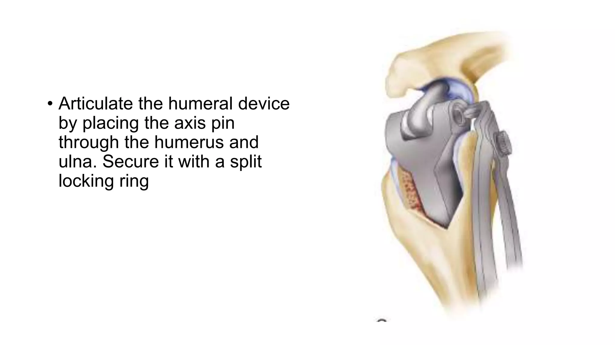 Total elbow arthroplasty | PPTX