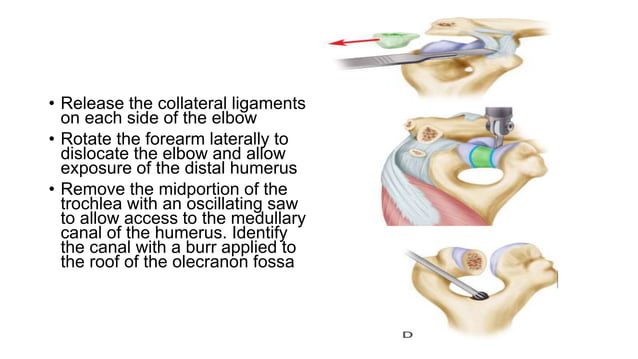 Total elbow arthroplasty | PPTX