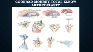 Total elbow arthroplasty for distal humerus fractures provided similar ...