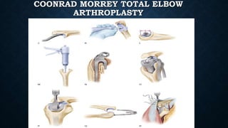 Total elbow arthroplasty for distal humerus fractures provided similar ...