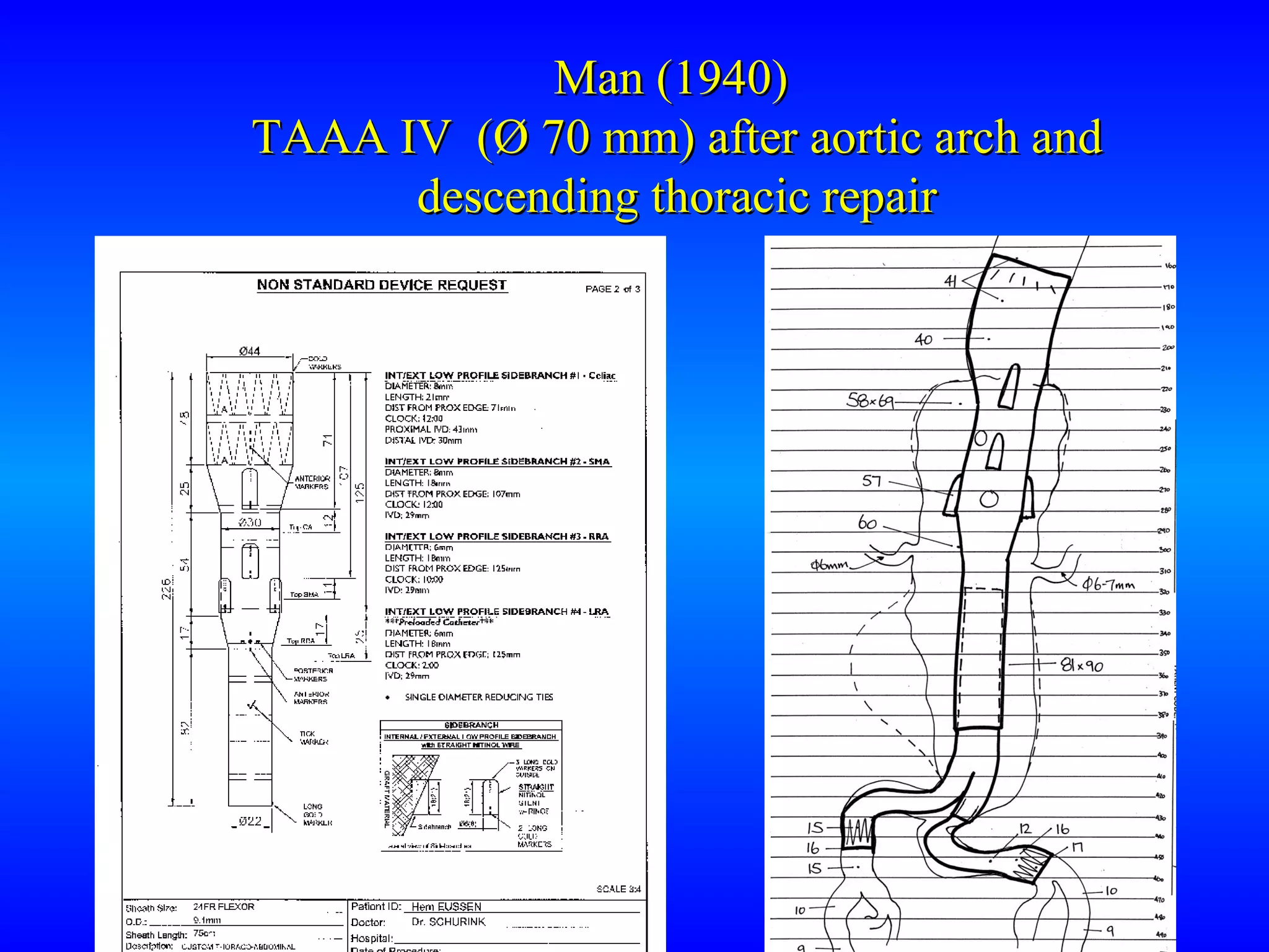 Total endovascular repair for thoraco abdominal aortic aneurysms | PPT
