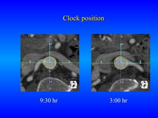 Total endovascular repair for thoraco abdominal aortic aneurysms | PPT