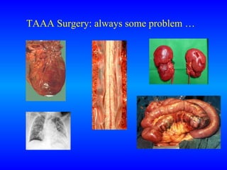 Total endovascular repair for thoraco abdominal aortic aneurysms | PPT
