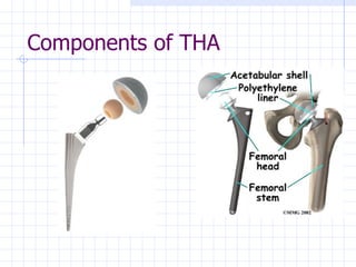 Total Hip Arthroplasty For Ccu | PPT