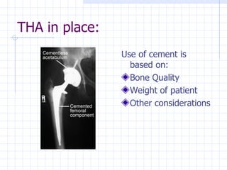 Total Hip Arthroplasty For Ccu | PPT