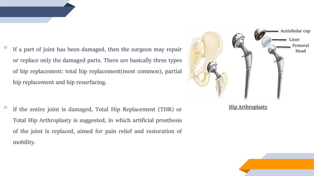 Total Hip Implant | PPTX