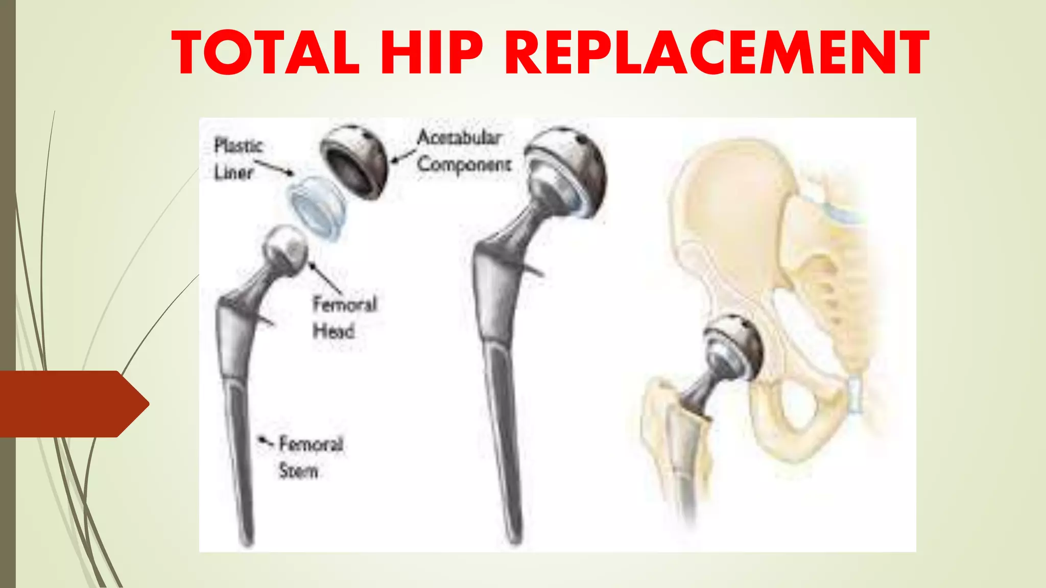 Total hip replacement | PPSX