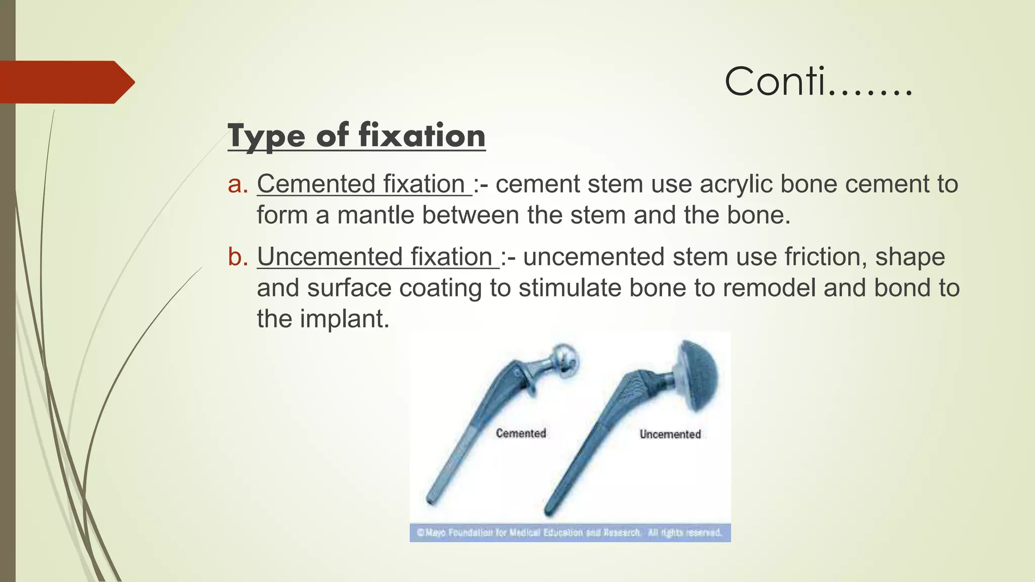 Total hip replacement | PPSX