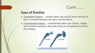 Total hip replacement | PPSX