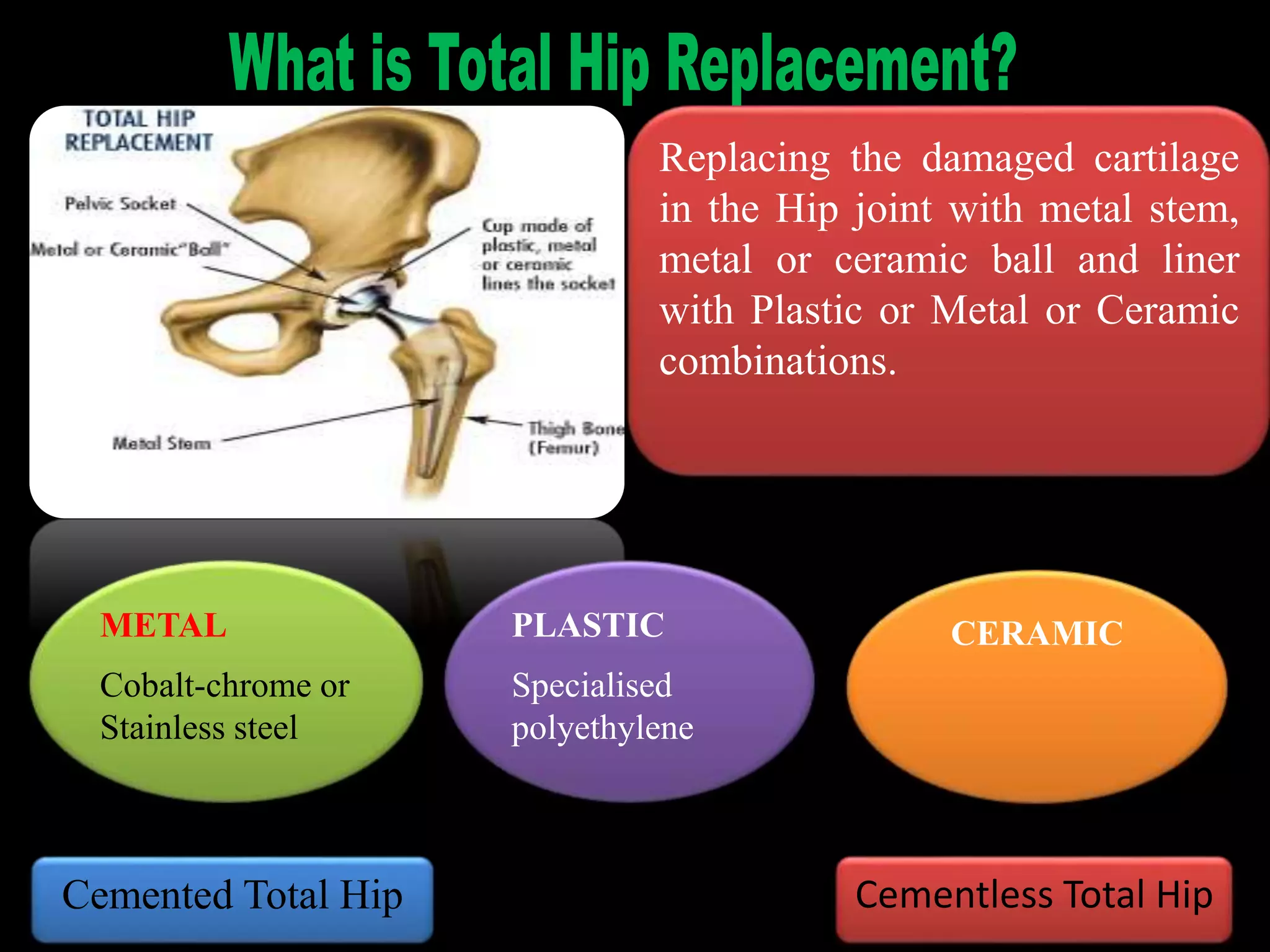 Total hip replacement | PPTX